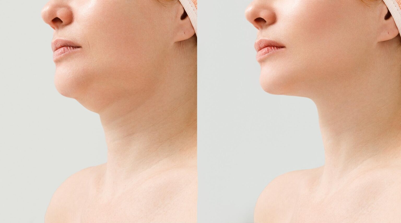 How to Get Rid of a Double Chin Without Surgery Using the V-Shape ...